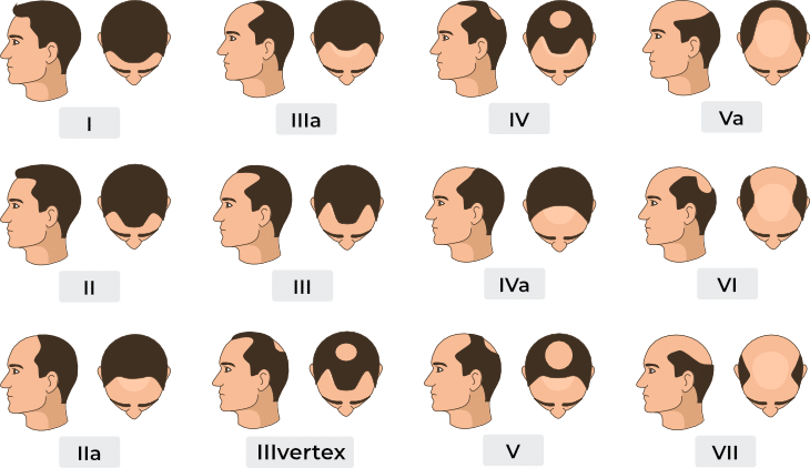 Norwood Hamilton Scale Smile Hair Clinic