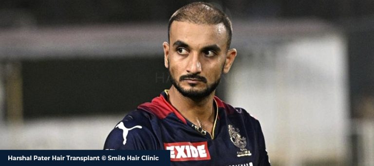 Harshal Patel Hair Transplant - Smile Hair Clinic