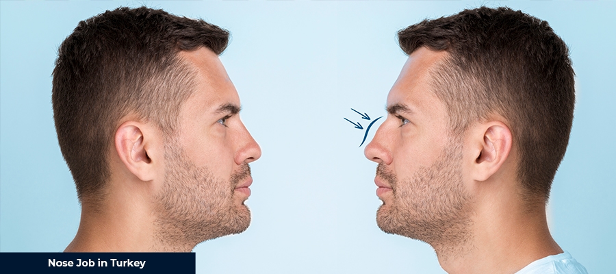 The Advantages of Nose Job in Turkey Cost 2026 - Smile Hair Clinic