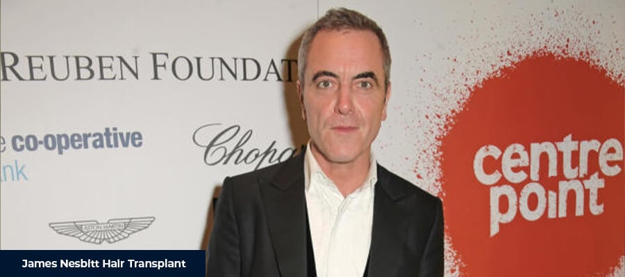 James Nesbitt hårtransplantation | Smile Hair Clinic