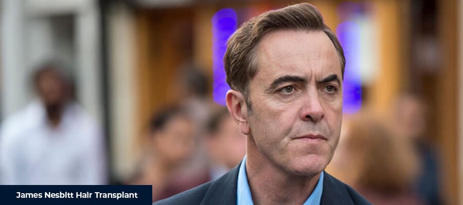 James Nesbitt hårtransplantation | Smile Hair Clinic