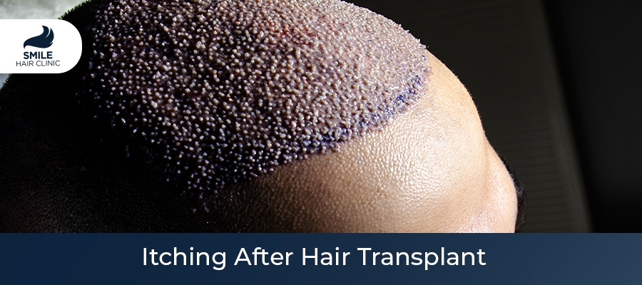 Itching After Hair Transplant | Smile Hair Clinic
