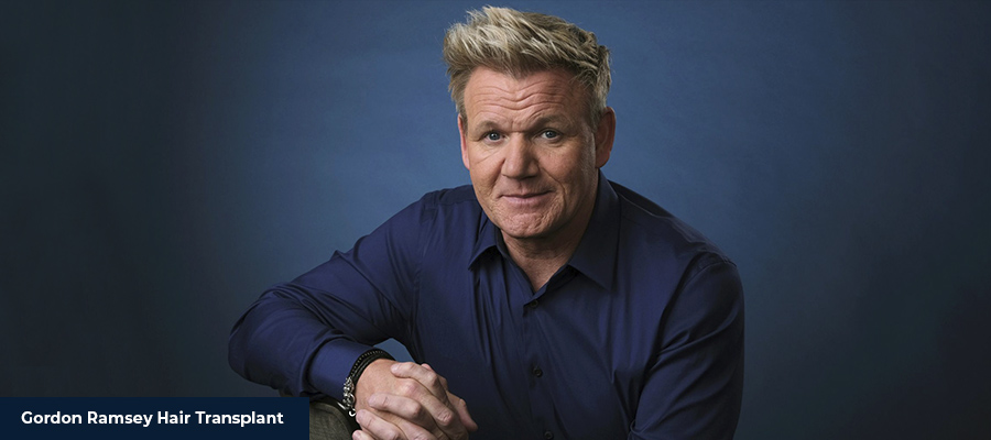 Chef Gordon Ramsay Hair Transplant - Smile Hair Clinic