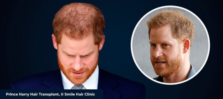 Transplante capilar do Príncipe Harry | Smile Hair Clinic