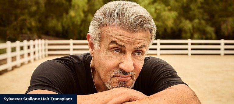 Sylvester Stallone Hair Transplant | Smile Hair Clinic