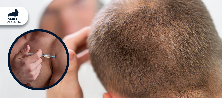 Testosterone Injections and Hair loss - Smile Hair Clinic