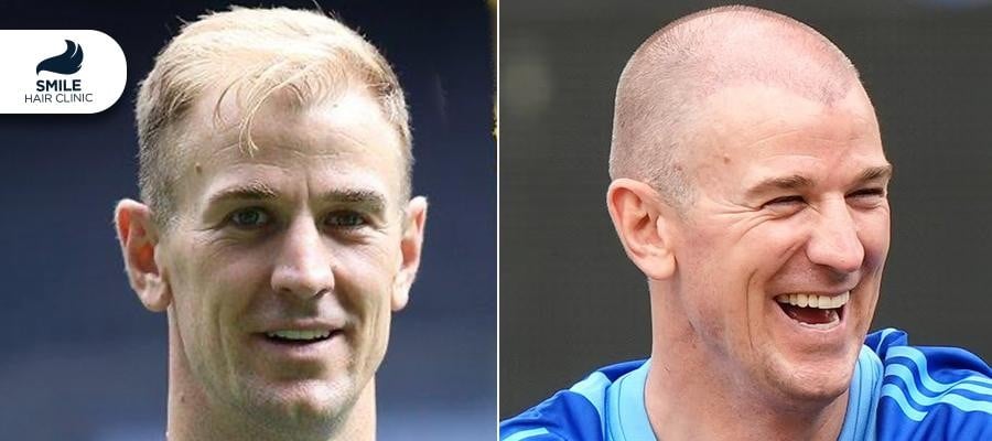Transformation capillaire de Joe Hart | Smile Hair Clinic